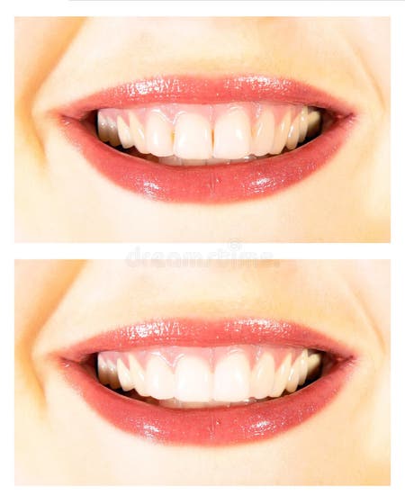 White teeth wide smile stock image. Image of remove, dent - 7938817