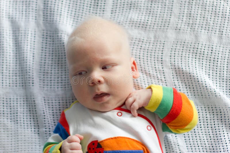 Whitehair Babyboy Mit Albinismussyndrom Stockfoto - Bild von ...