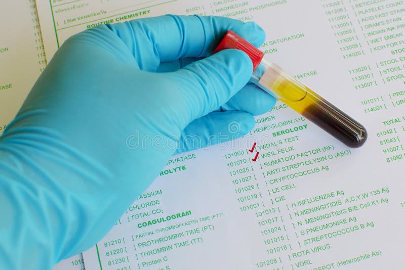 Widal Weil Felix testing stock image. Image of bacteria - 57916073