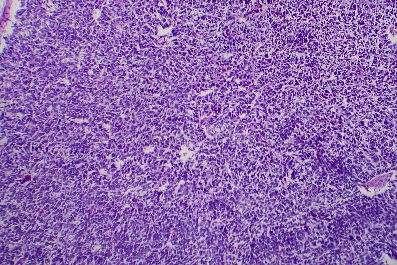 Wilms Tumor, Light Micrograph Stock Image - Image of neoplasia ...