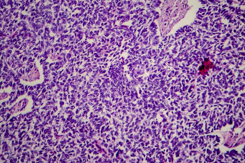 Wilms Tumor, Light Micrograph Stock Photo - Image of magnification ...