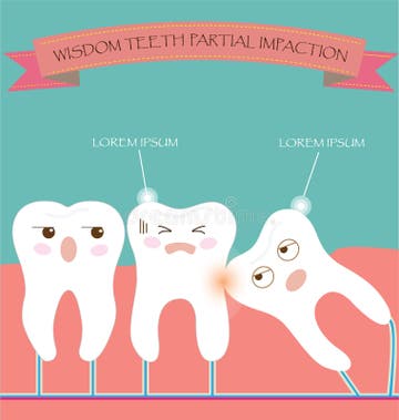 Wisdom Teeth Partial Eruption Impaction Stock Vector - Illustration of ...