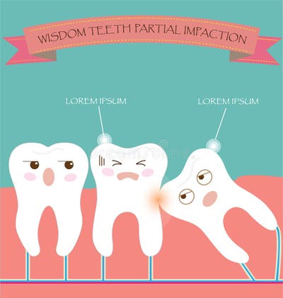 Wisdom Teeth Partial Eruption Impaction Stock Vector - Illustration of ...