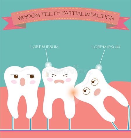 Wisdom Teeth Partial Eruption Impaction Stock Vector - Illustration of ...
