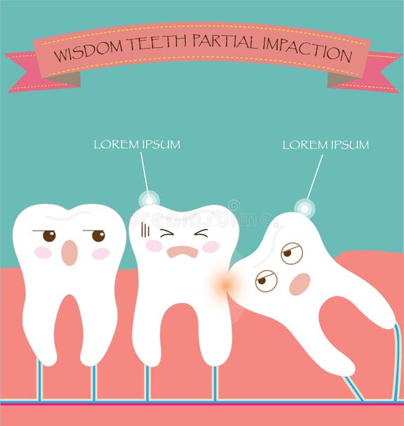 Wisdom Teeth Partial Eruption Impaction Stock Vector - Illustration of ...
