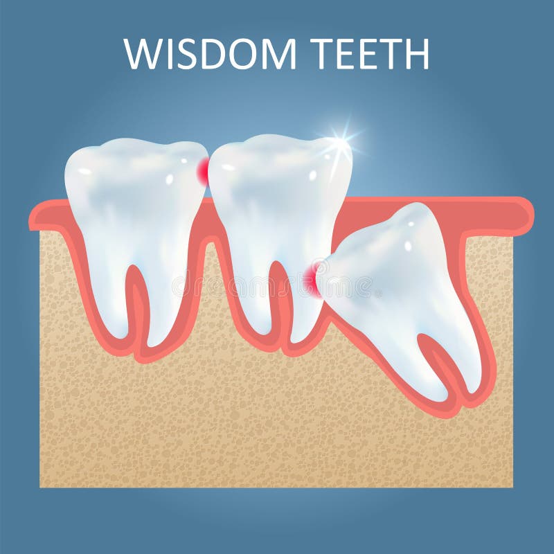 Wisdom Teeth Problems Vector Poster Design Template Stock Vector ...