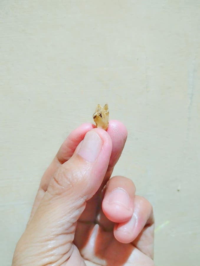 Wisdom Teeth or Third Molars Fall Out on Their Own Stock Illustration ...