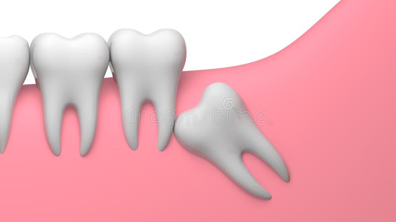 Wisdom Tooth Angular Impaction Illustration, 3D-rendering, White ...