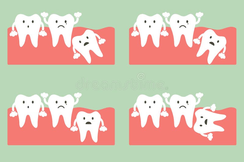 Wisdom tooth stock vector. Illustration of dental, angular - 85255862