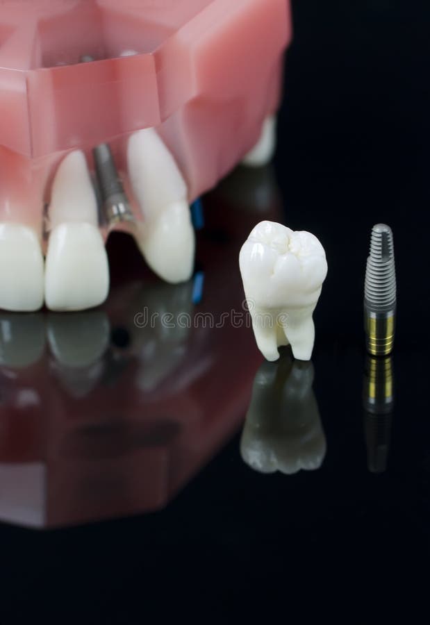 Wisdom Tooth, Implant and Teeth Model. Stock Image - Image of ...