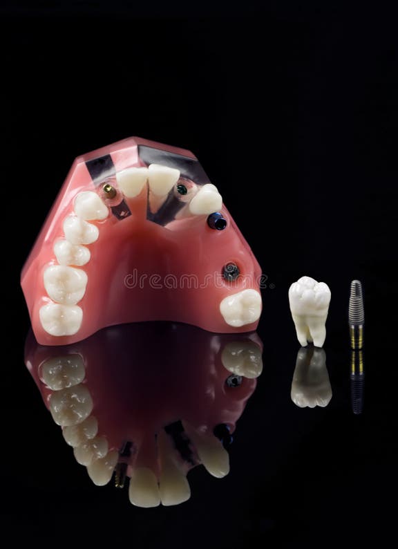 Wisdom Tooth, Implant and Teeth Model Stock Image - Image of ...