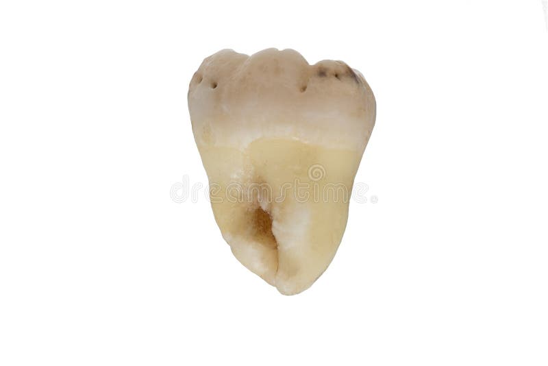 Wisdom Tooth on White Background Stock Photo - Image of clean ...