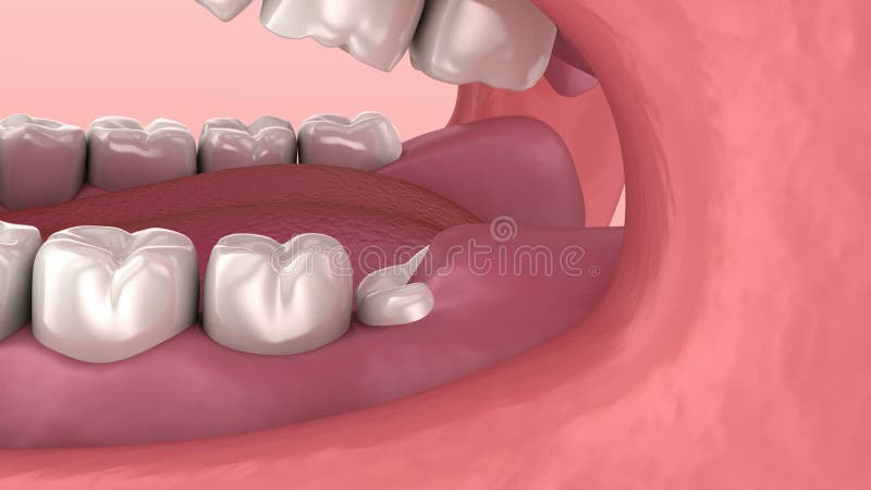 Wisdom tooth problem. stock video. Video of denture - 180595255