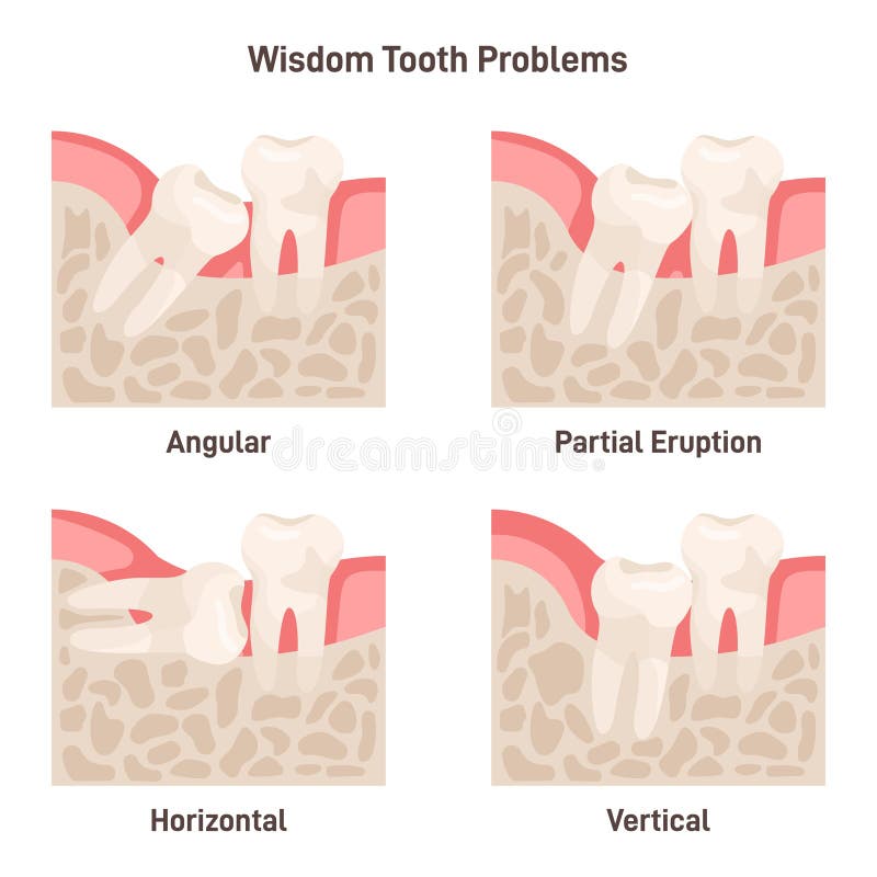 Wisdom Tooth Problems Set. Impaction, Wisdom Teeth Growing with Wrong ...