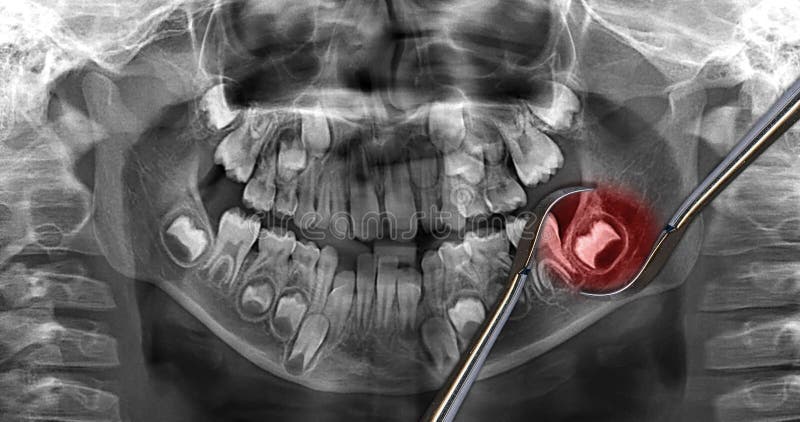Dental Scan , Types of Fixed Appliances Stock Image - Image of bite ...