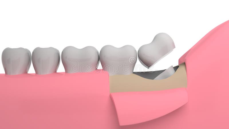 Wisdom Tooth, 3D-rendering, White Background, 3D-rendering, White ...