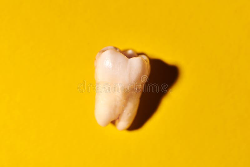 Wisdom Tooth with Tooth Decay, Isolated White Background Stock Image ...