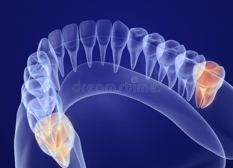 Wisdom Tooth Xray View. Medically Accurate Tooth 3D Illustration Stock ...