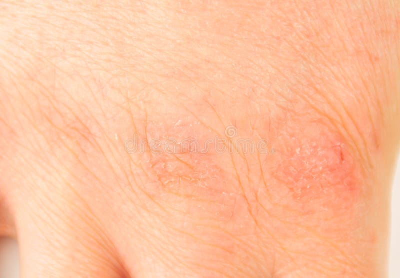 Withered Hand Cold Weather Stock Photos - Free & Royalty-Free Stock ...