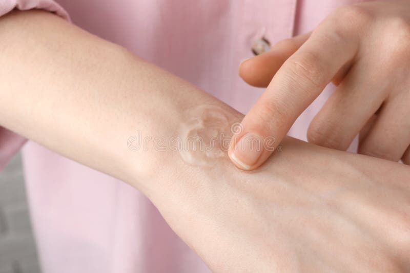 Woman Applying Ointment on Her Hand, Closeup Stock Image - Image of ...