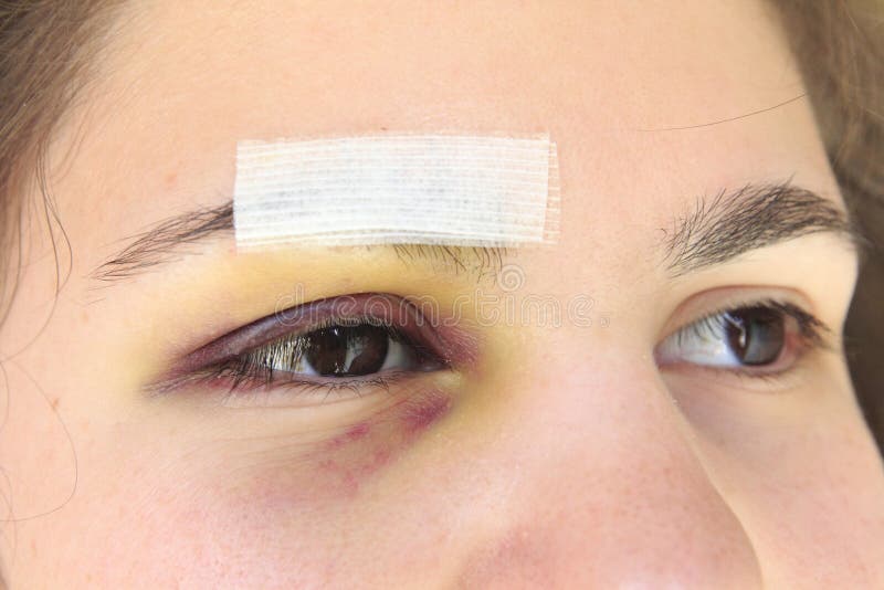 Shiner stock image. Image of bruise, health, green, healthcare - 34995429