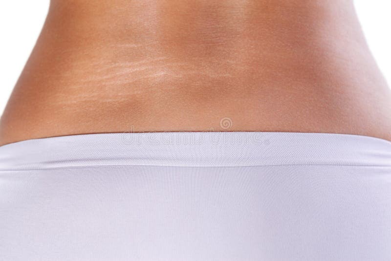 Woman Body with Stretch Marks Stock Image - Image of isolated ...