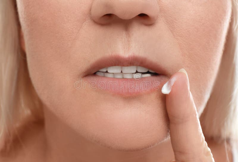 Woman with Cold Sore Applying Cream on Lips, Closeup Stock Image ...
