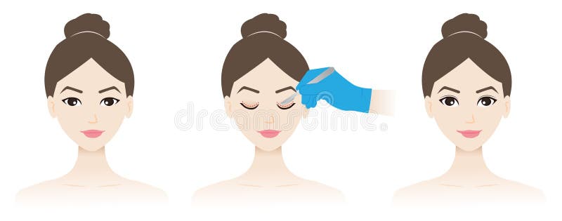 The Woman with Double Eyelid Surgery before and after Vector ...