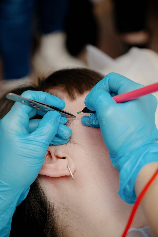 Woman on Electro-epilation of the Face. Hardware Permanent Removal of ...