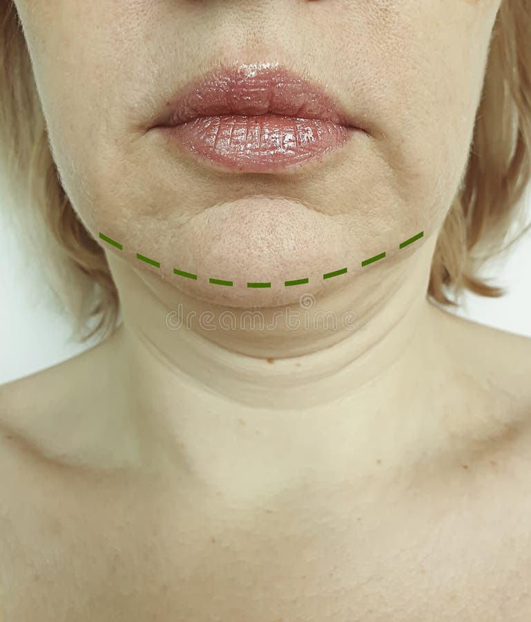 Woman Face Double Chin Unaesthetic Stock Photo - Image of flaw ...