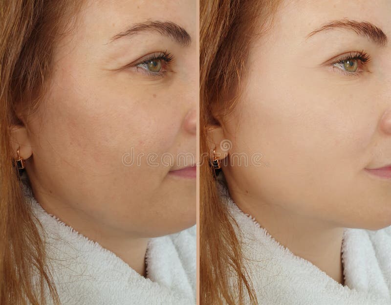 Woman Face Wrinkle before and after Treatment Stock Photo - Image of ...