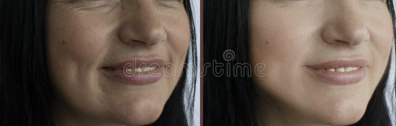 Woman Face Wrinkles Before And After Saggy Patient Double Chin Treatment Stock Image Image Of