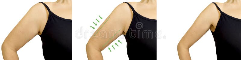 Woman Fat Hand Before And After Stock Photo - Image of excess, hand ...