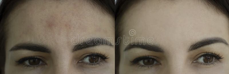 Woman Forehead Acne before Difference after Treatment Stock Photo ...