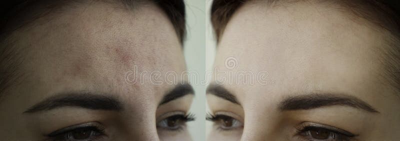 Woman Forehead Acne before after Treatment Stock Photo - Image of ...