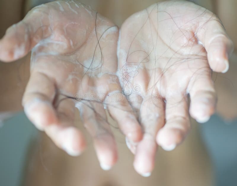 A Woman Has Hair Falling Out Stock Photo - Image of beauty, receding ...