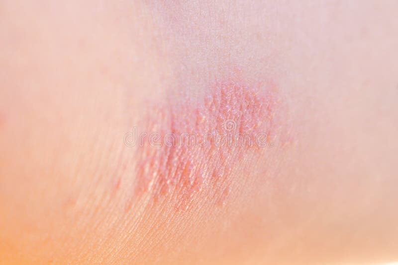 Woman has rash on her arm stock image. Image of care - 133850411