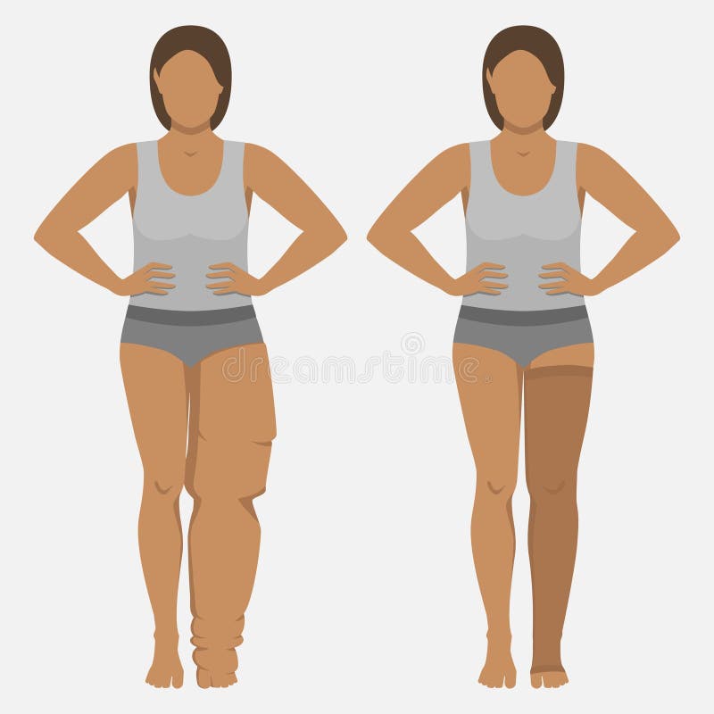 Compression Stocking Stock Illustrations – 248 Compression Stocking ...