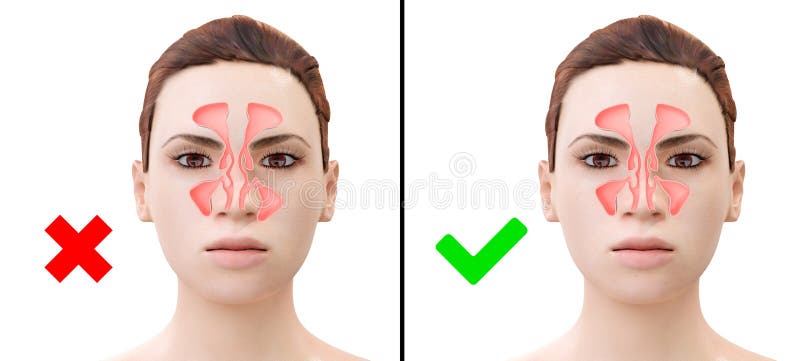 Woman Before And After Nasal Septum Deviation Correction Stock Illustration Illustration Of