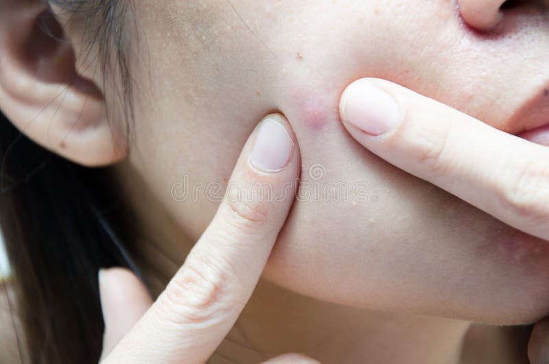 Woman Pressing Pimple Her Chick Stock Photos - Free & Royalty-Free ...