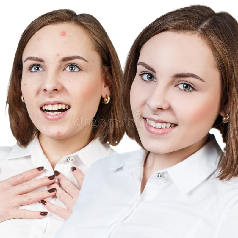 Woman with Problem Skin on Her Face Stock Image - Image of facial ...