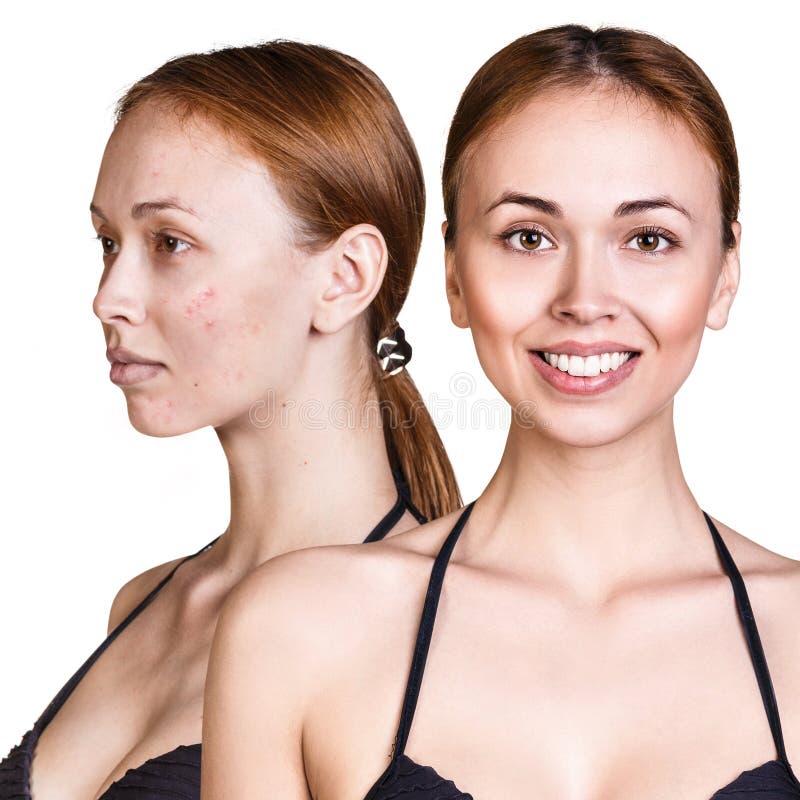 Woman with Problem Skin on Her Face Stock Image - Image of care, clean ...