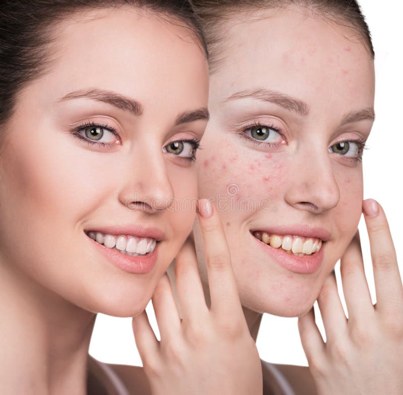 Woman with Problem Skin on Her Face Stock Image - Image of facial ...