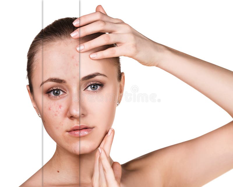 Woman with problem skin stock image. Image of acne, closeup - 79036705
