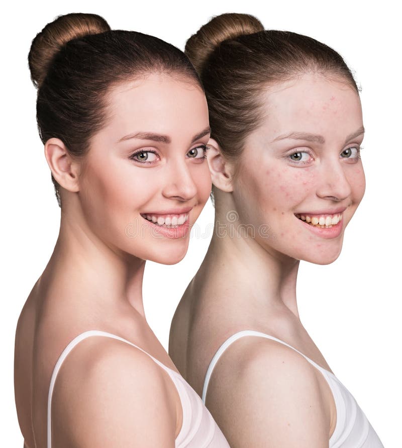 Portrait of Girl Woman with Problem and Clear Skin, Youth Concept Stock ...