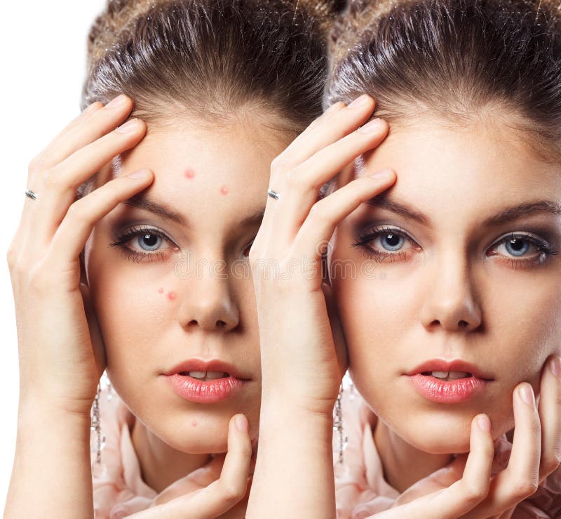 Woman with Problem Skin on Her Face Stock Photo - Image of complexion ...