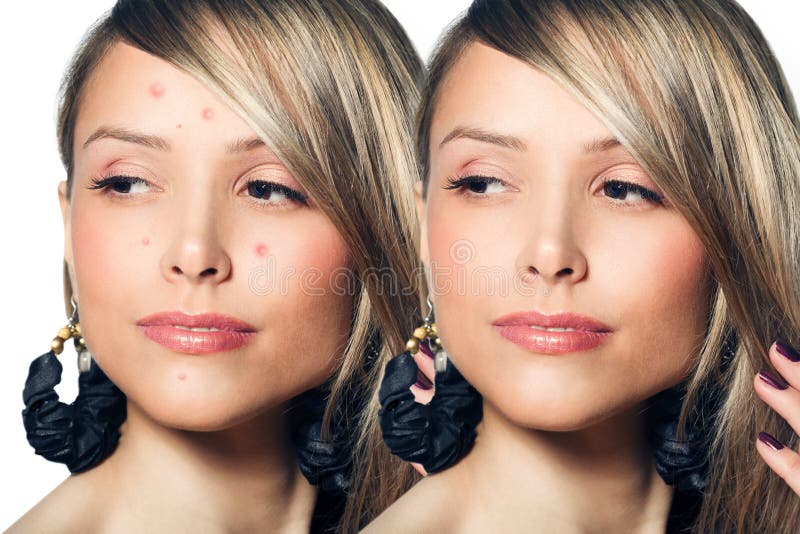 Woman with Problem Skin on Her Face Stock Photo - Image of face ...