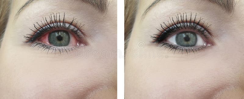 Woman Red Eye before and after Vision Problem Procedures Ophthalmology ...