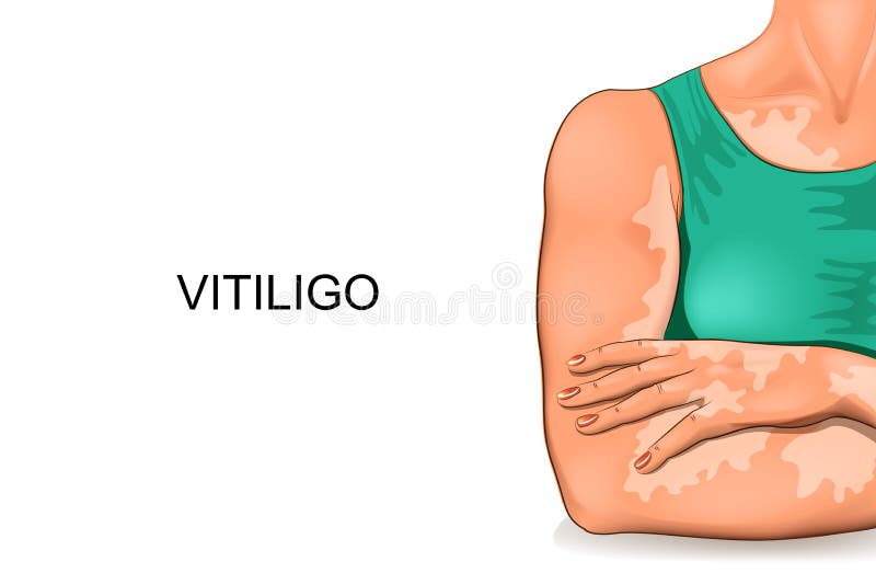 Vitiligo Affected African Girl with White Patches on Dark Skin. Stock ...