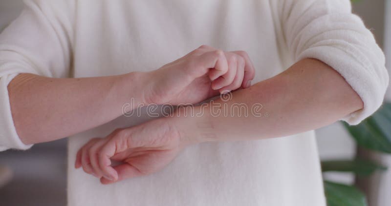 Close-Up of a Swollen Wound and Redness after a Midge Bite on the Hand ...